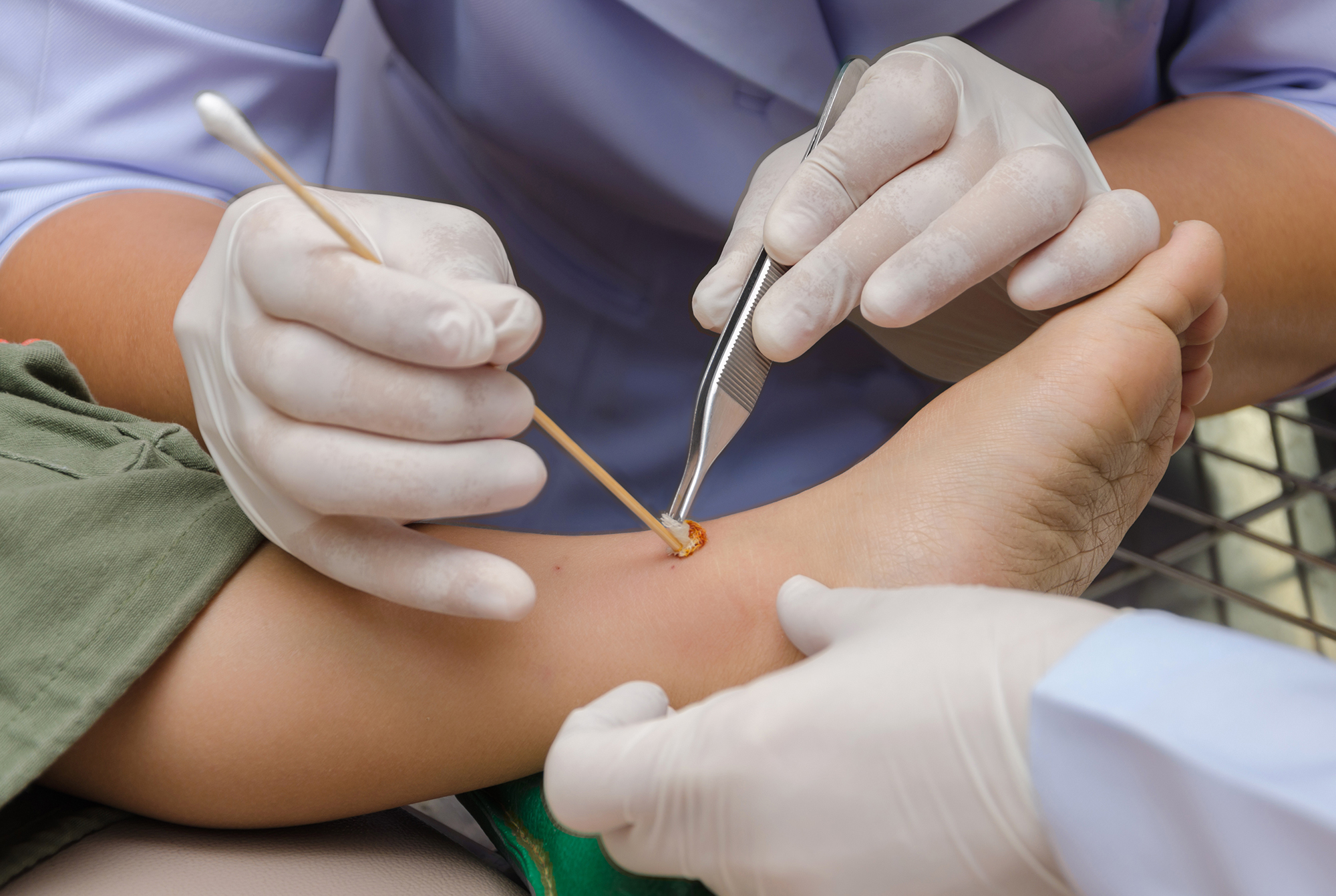 Wound Healing - Power of platelets